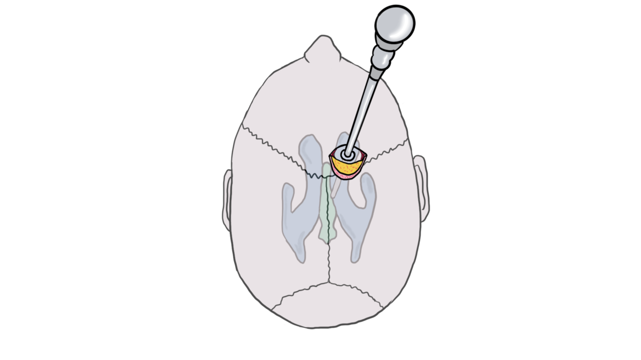 Hydrocephalus | Dr. Thomas Robert