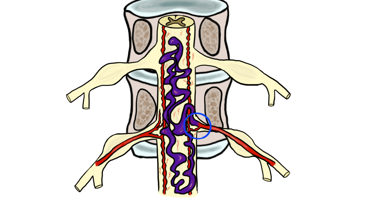 Medullary vascular malformations | Dr. Thomas Robert