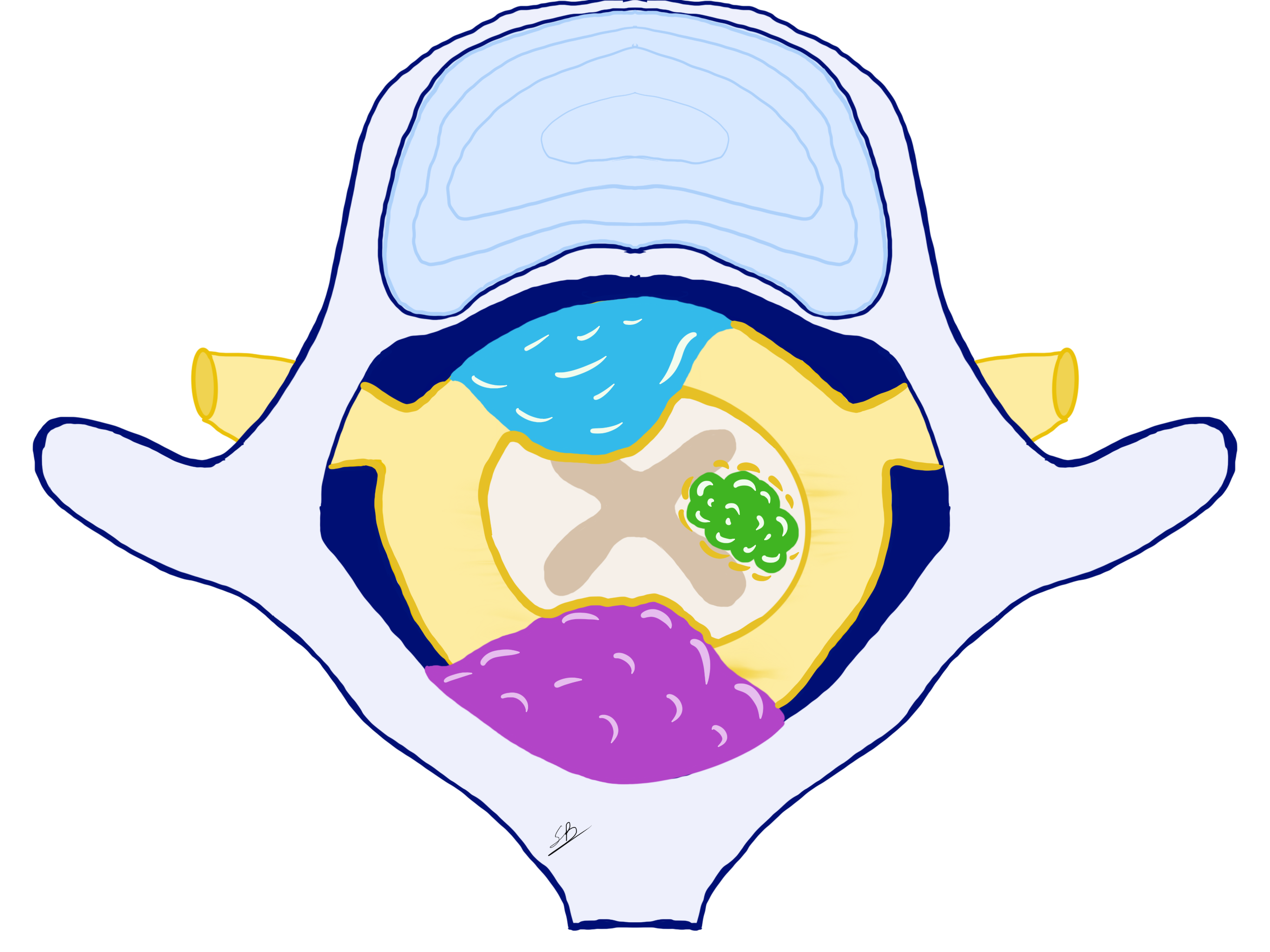 Vertebral tumors | Dr. Thomas Robert