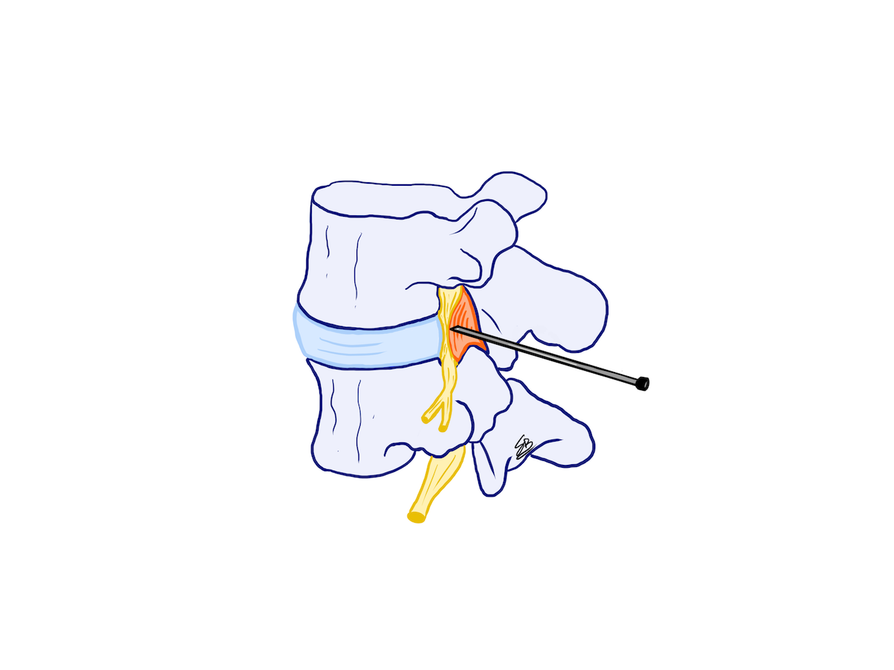 Ultrasound-Guided Spinal Injections | Dr. Thomas Robert